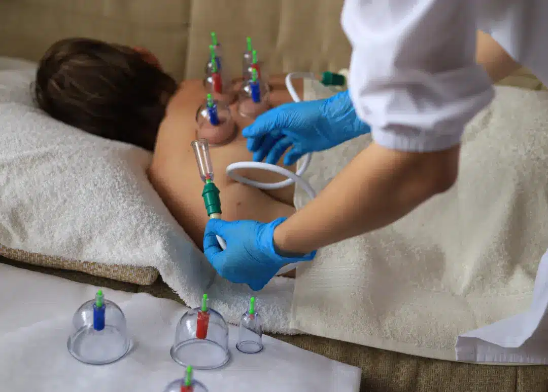 Exploring Cupping Therapy: Benefits and How It Works